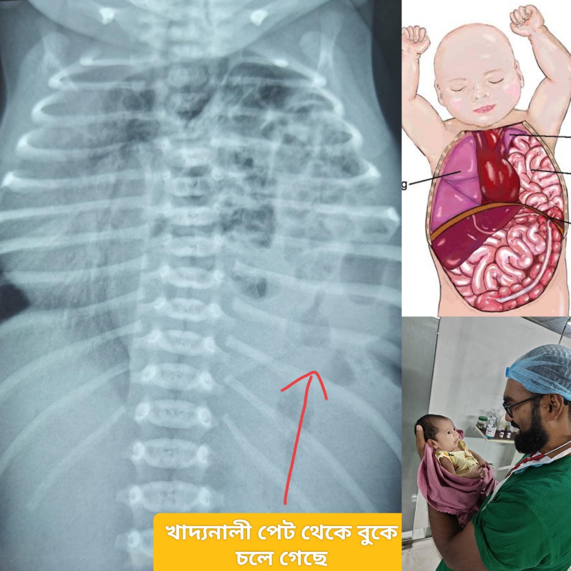 Congenital diaphragmatic hernia (CDH) - Dr. Samiul Hasan